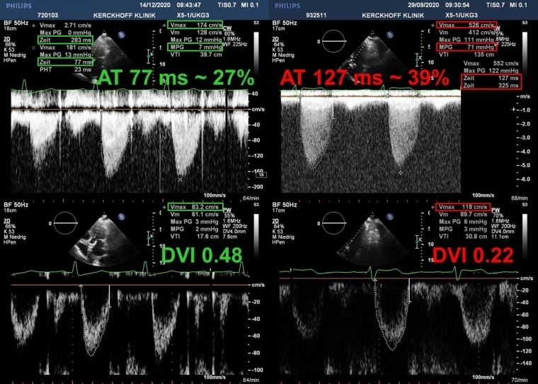 Prosthetic heart valves: Complications and dysf...